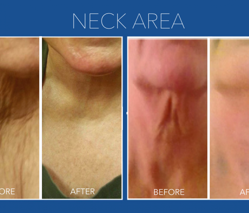 Skin Rejuvenation – Hannah T Spa